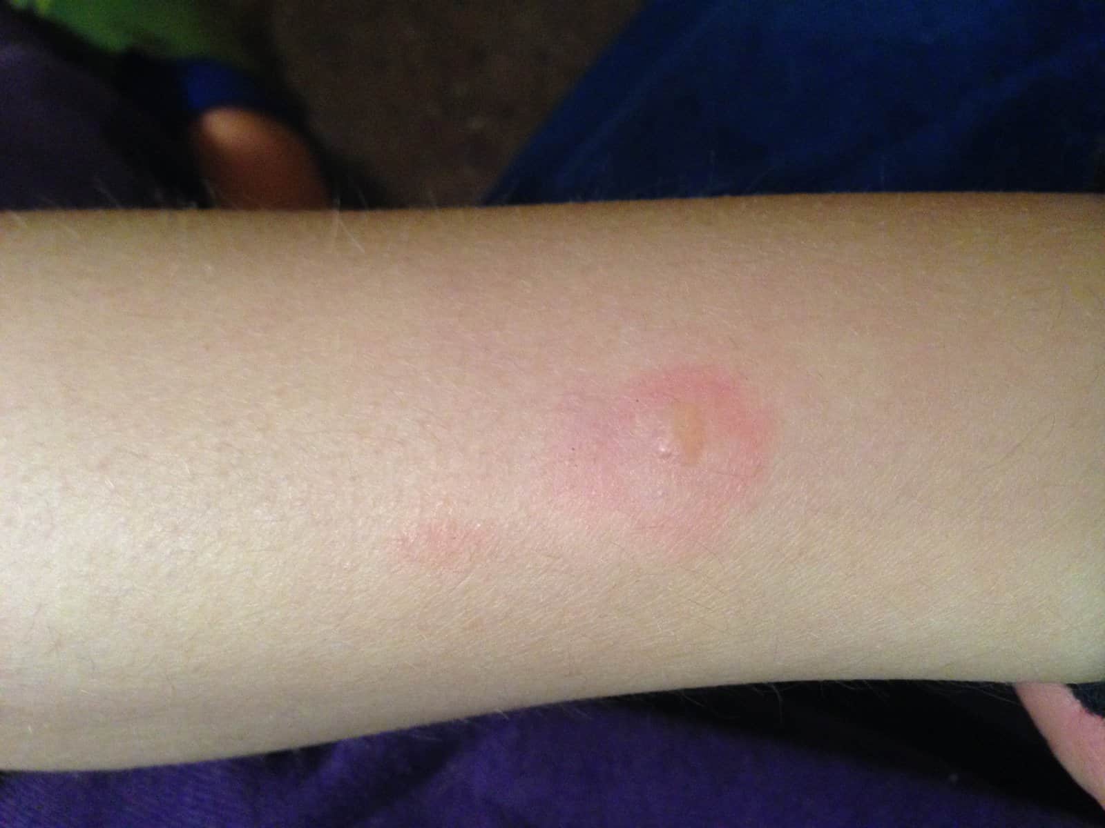 Brown Recluse Spider Bite! - Ridge Haven Homestead